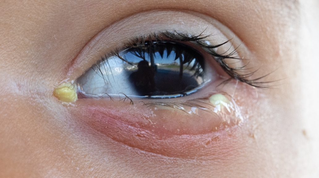 What Is Conjunctivitis | Pink Eye Treatment Guide